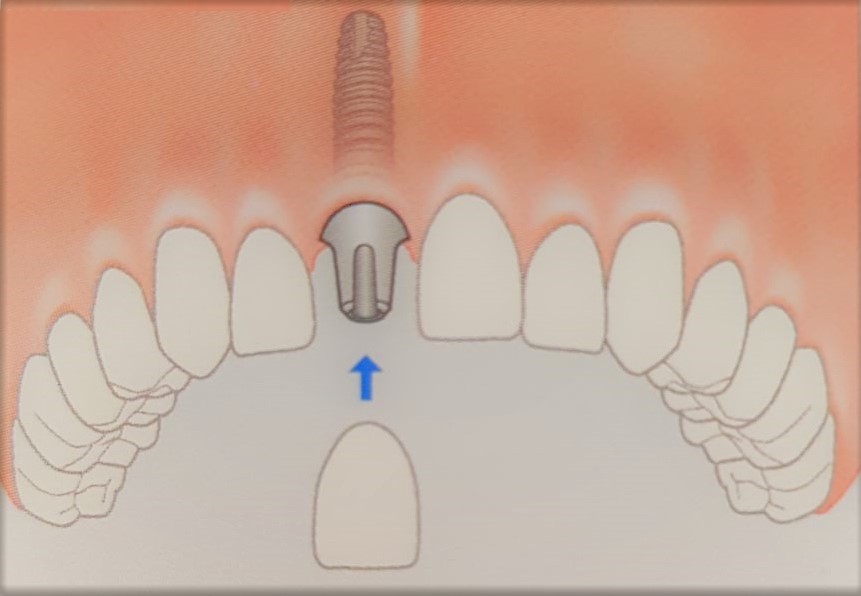 Change Your Smile For Life - Implants Rochester - Barnet (London ...