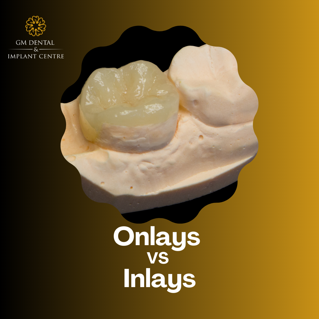 Dental Onlay VS Dental Inlay - GM Dental And Implant Centre